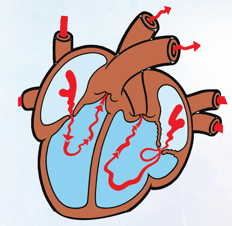 What is RHD? - Heart Heroes Fiji